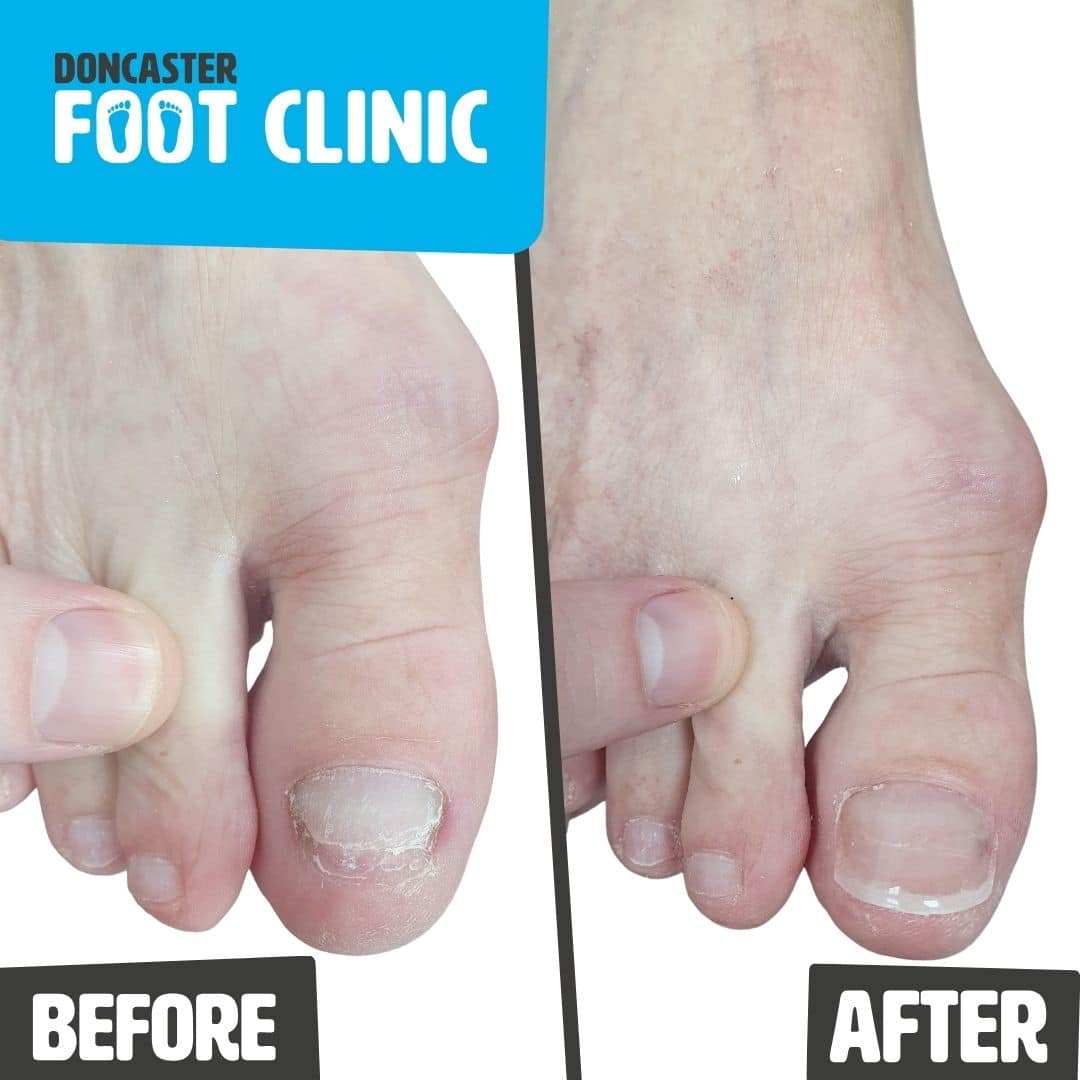 Revolutionary Cosmetic Toenail Reconstruction | Doncaster